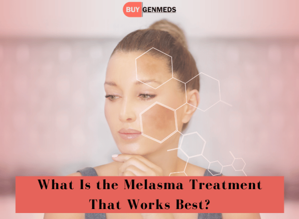 What Is the Melasma Treatment That Works Best?